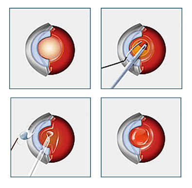 Cataracts Causes, Symptoms, & Treatment | South East Eye